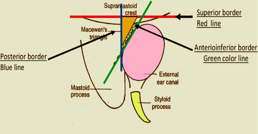 Ear Surgery Questions? Dr. Juvekar Explains Macewen's Triangle